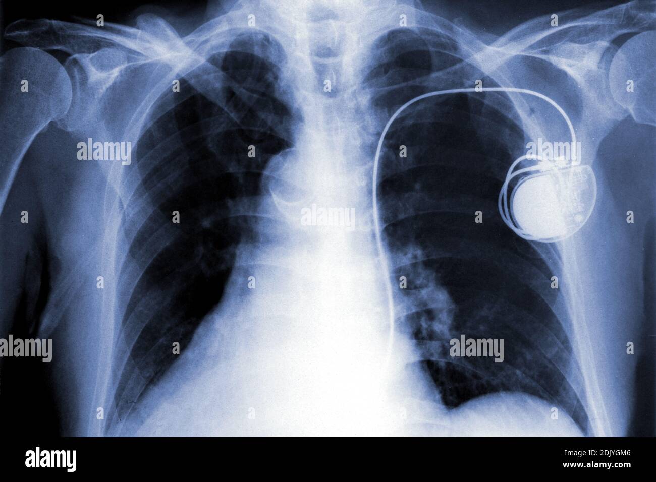 Pacemaker X Ray High Resolution Stock Photography and Images - Alamy
