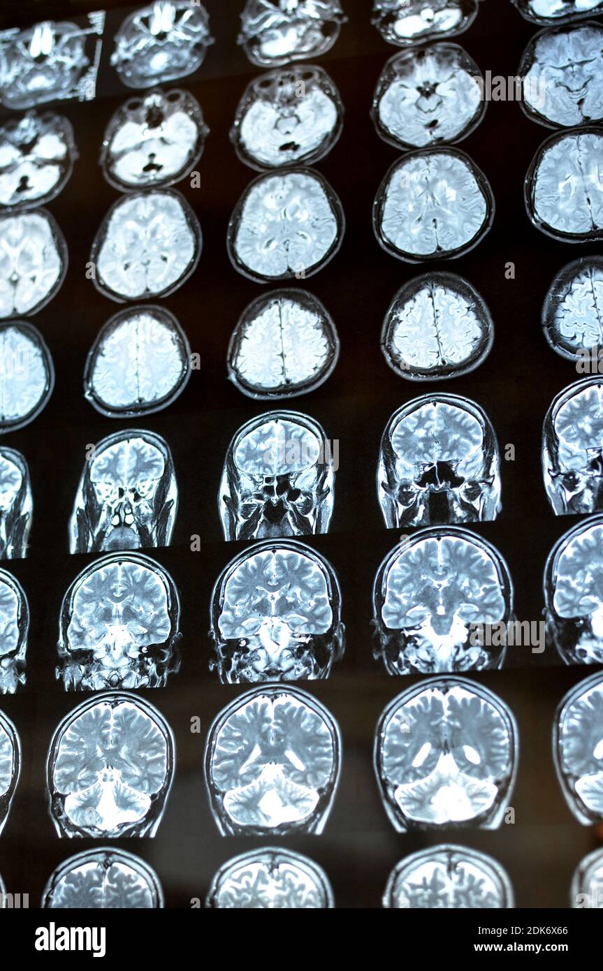Magnetic resonance image scan of the brain with a colloid cyst. MRI ...