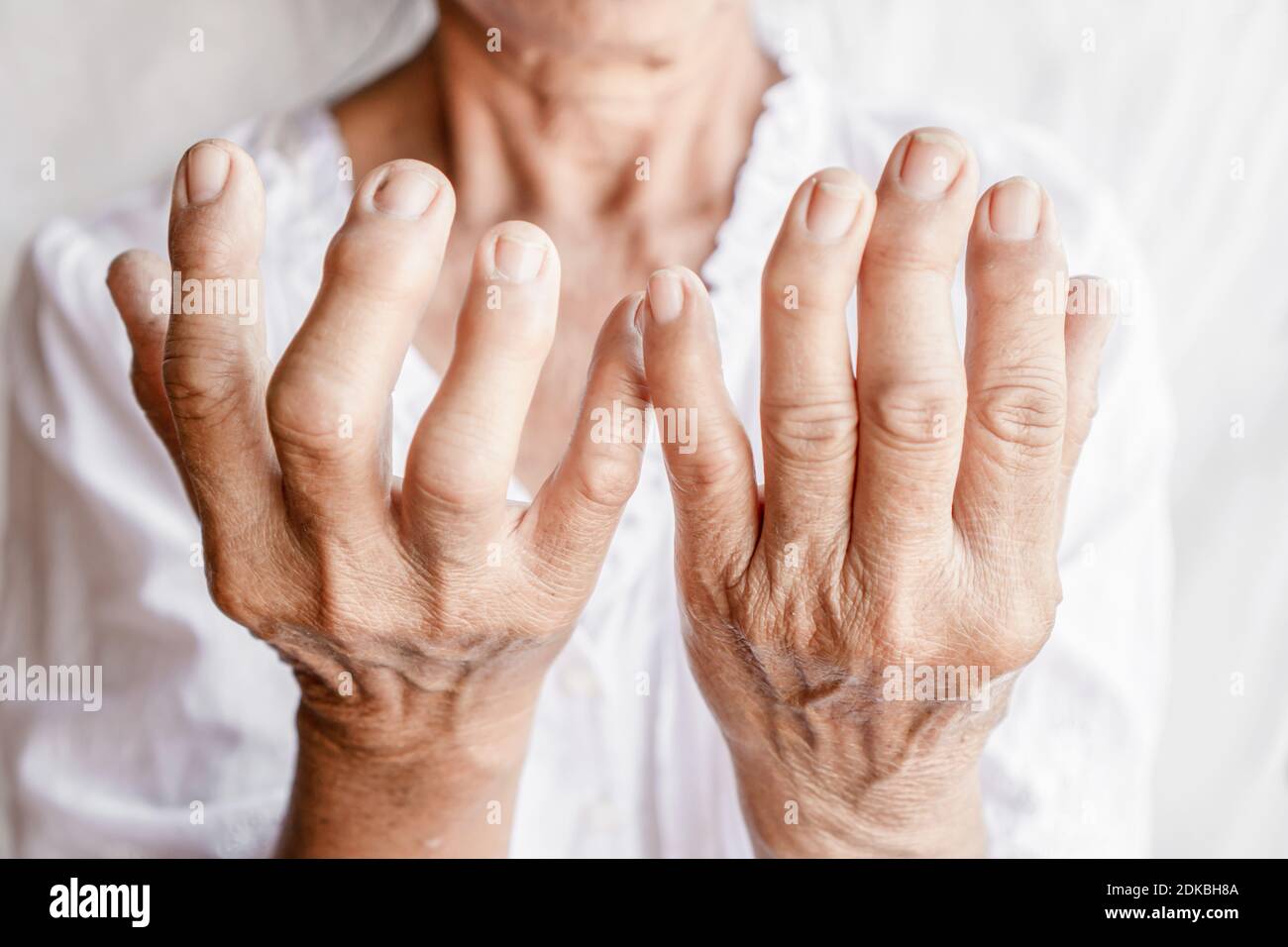 Fractured Finger Hand High Resolution Stock Photography and Images - Alamy