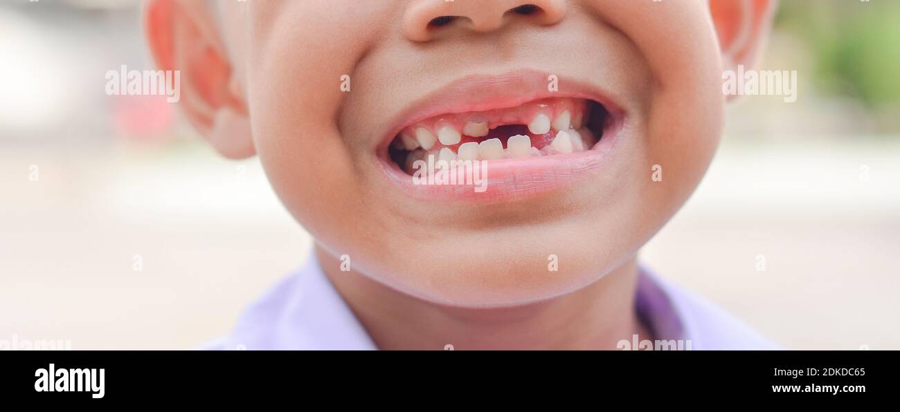 Boy broken teeth hi-res stock photography and images - Alamy