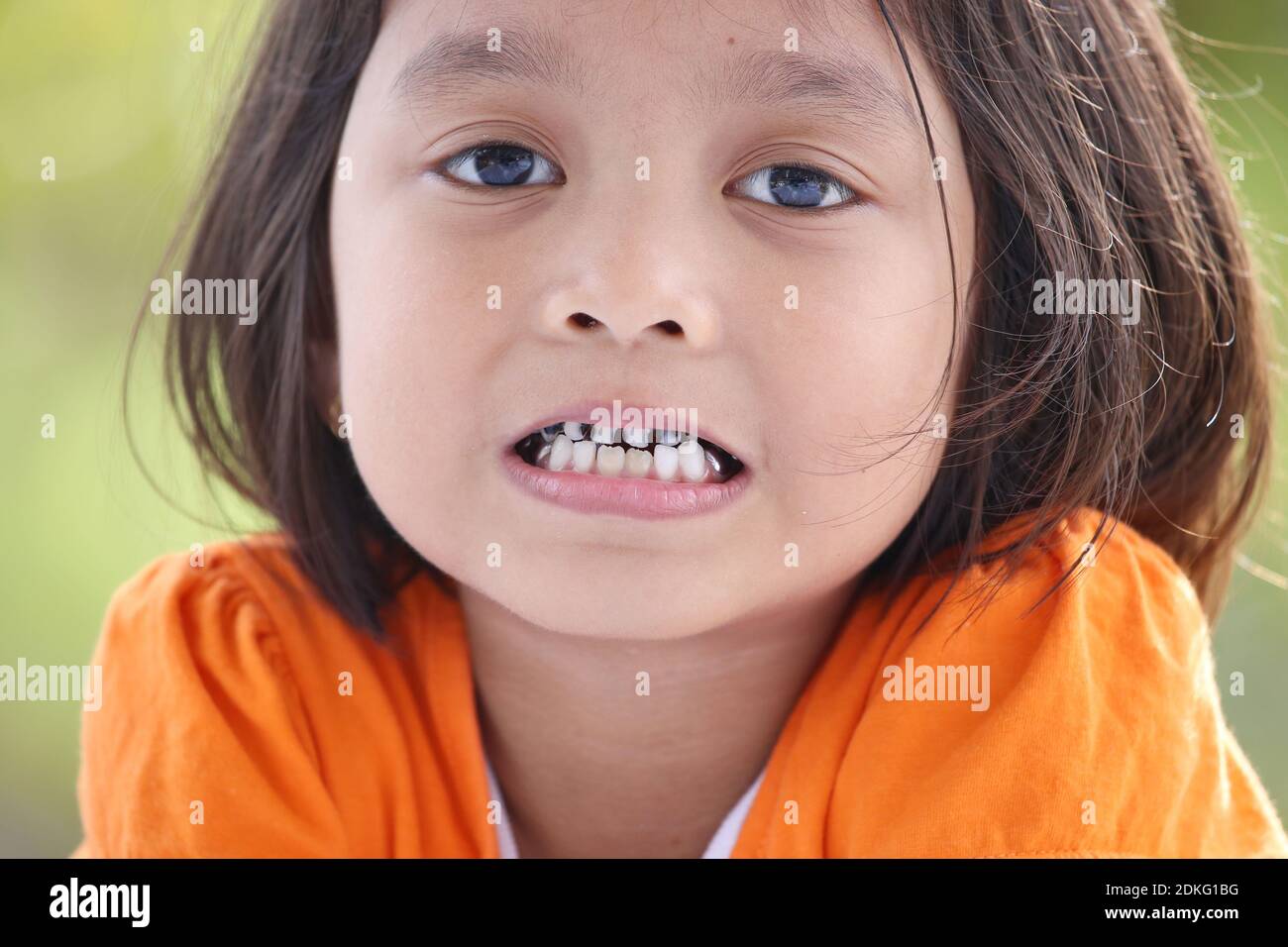 Rotting rotten teeth hi-res stock photography and images - Alamy