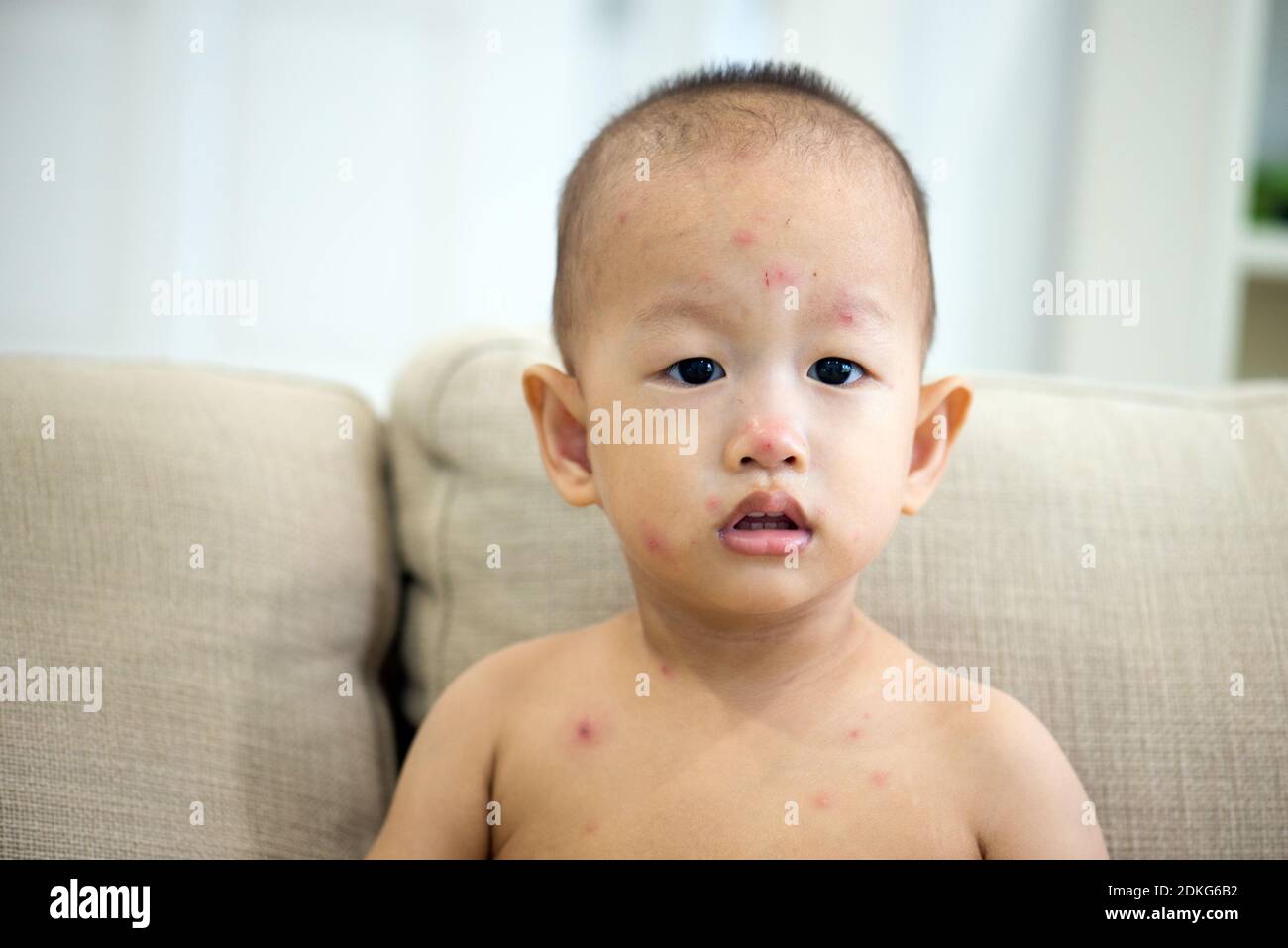 Child with red spots on face hi-res stock photography and images - Alamy