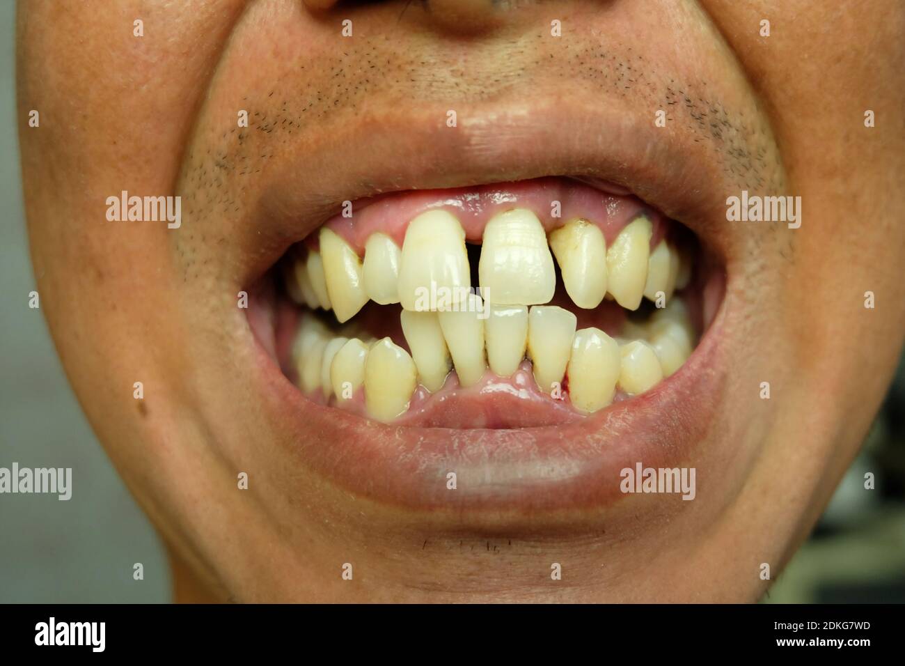 Adult man crooked teeth hi-res stock photography and images - Alamy
