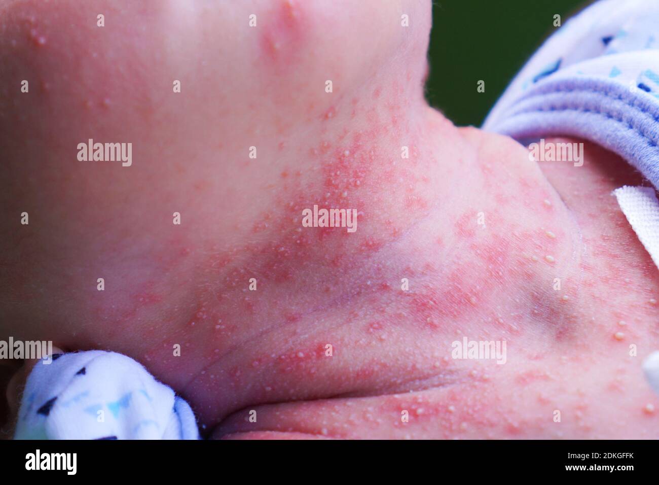 Baby acne hi-res stock photography and images - Alamy