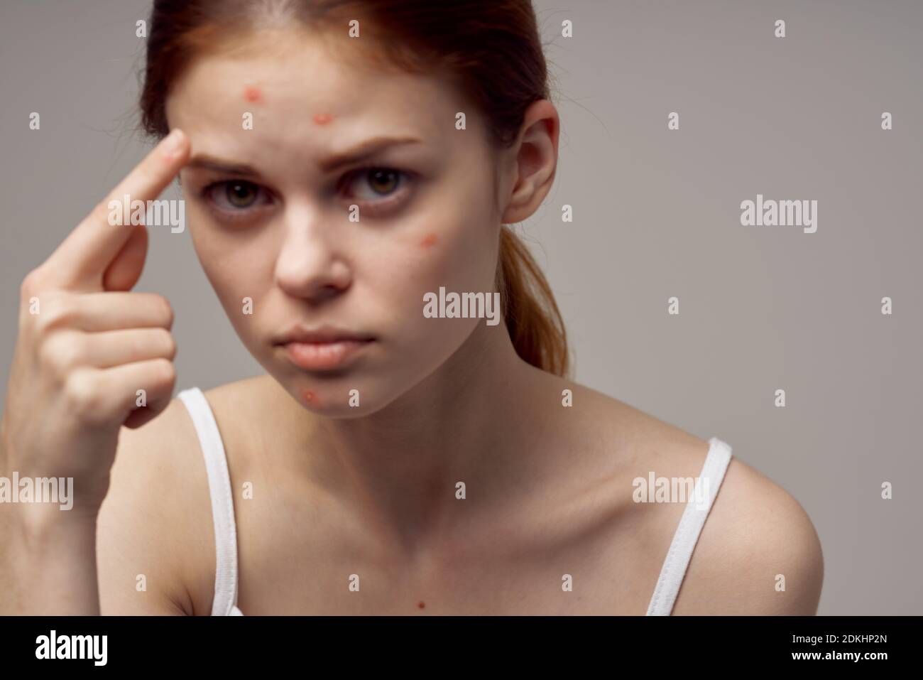 woman with pimple on her face touching face with hands health problems ...