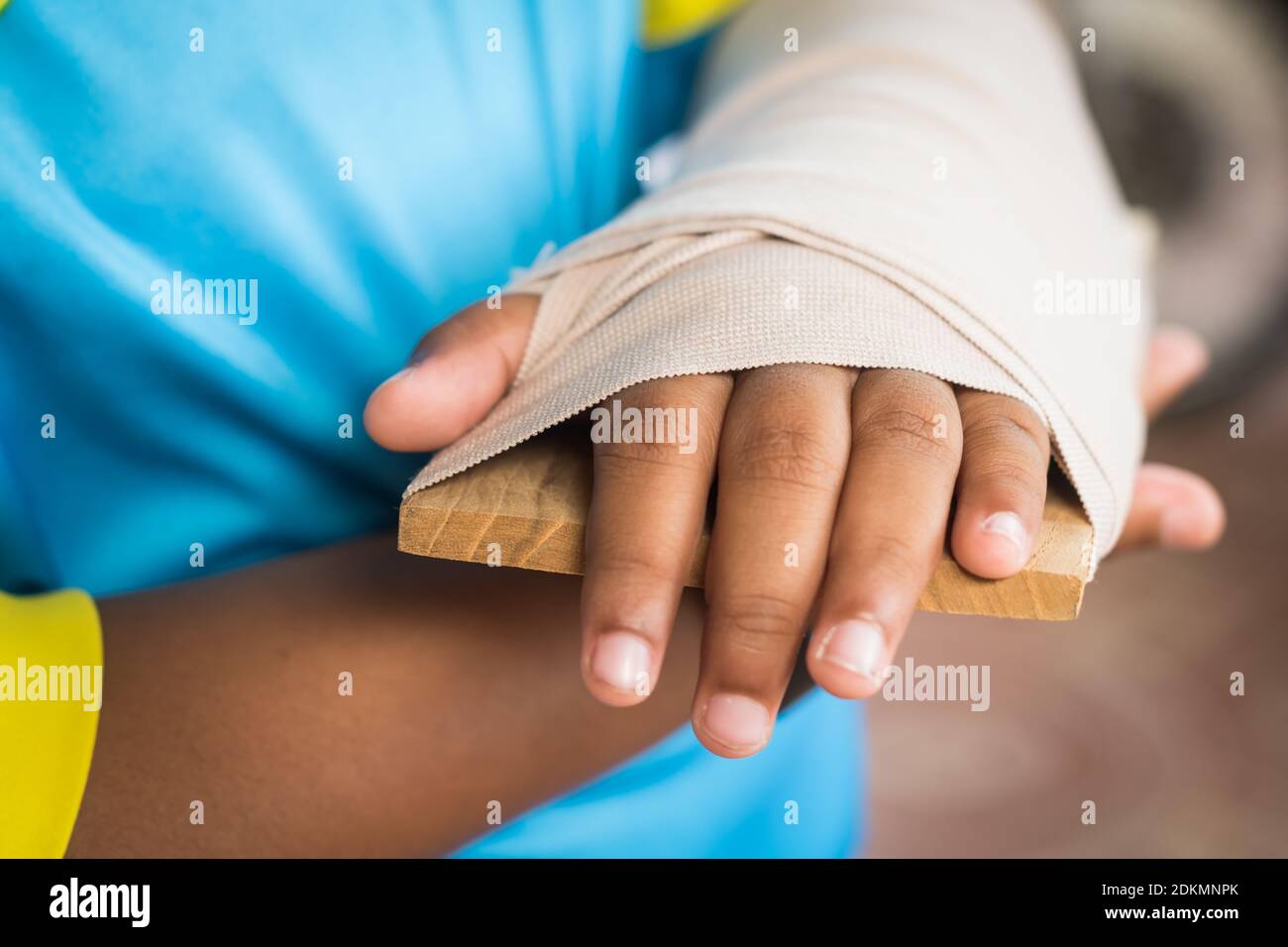 Bone Fracture First Aid High Resolution Stock Photography and Images ...