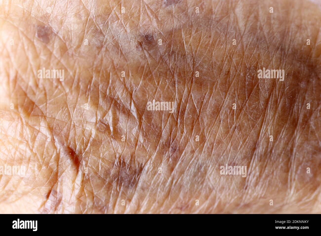 Atrophy Skin High Resolution Stock Photography and Images - Alamy