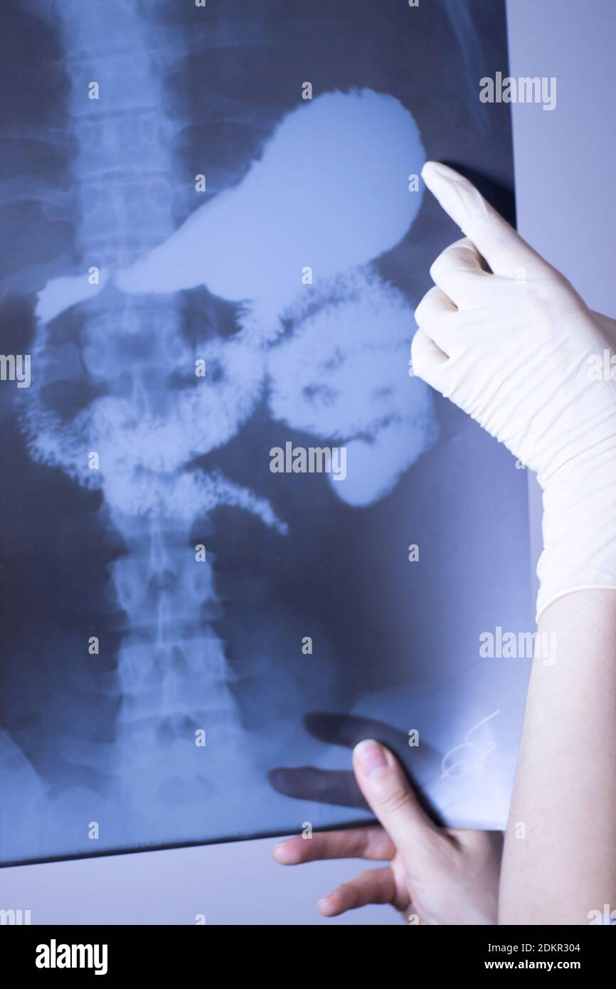 Human X Ray Stomach High Resolution Stock Photography and Images - Alamy