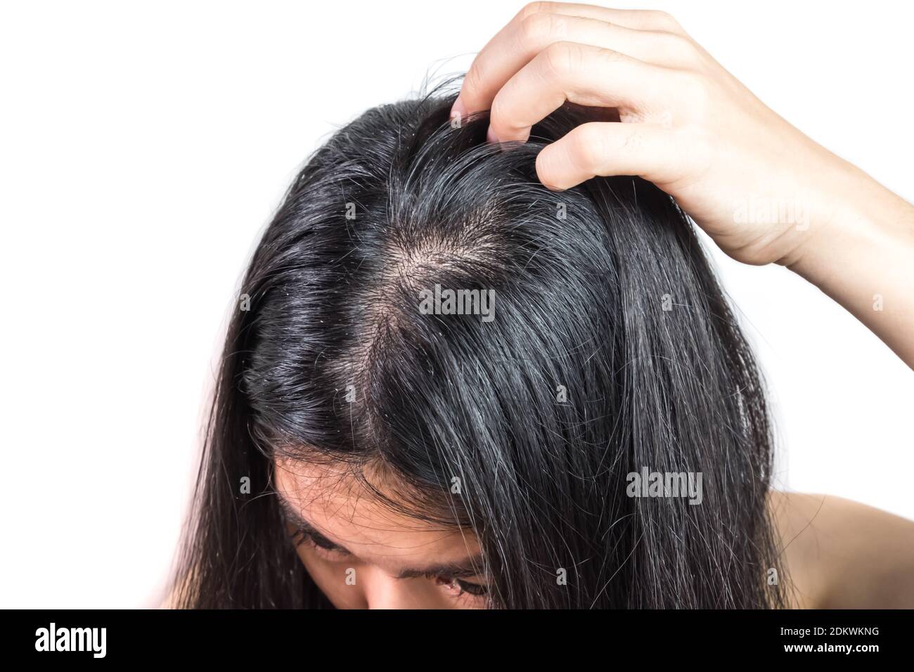 Scale dandruff hi-res stock photography and images - Alamy