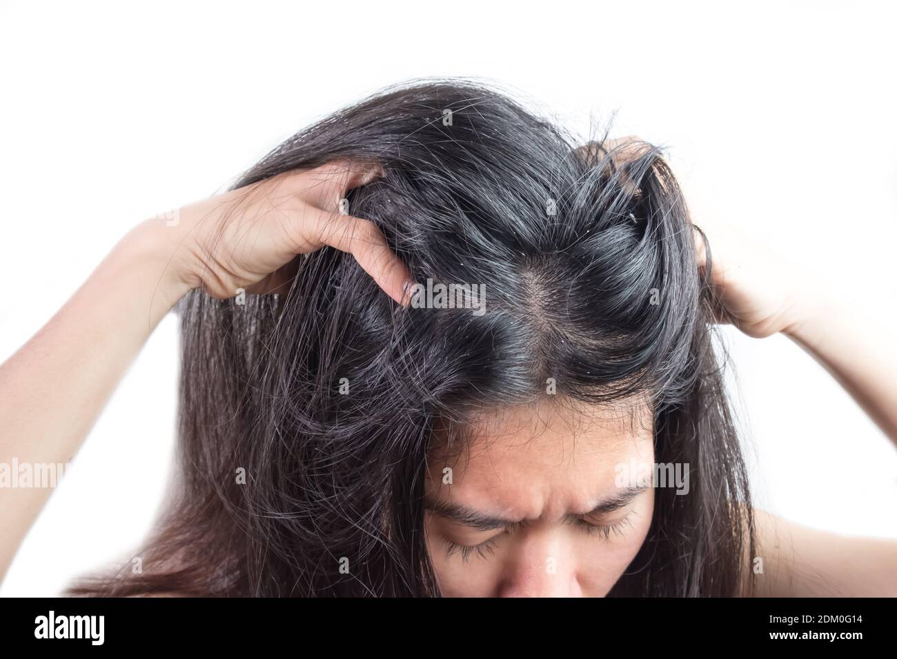 Dandruff black hi-res stock photography and images - Alamy