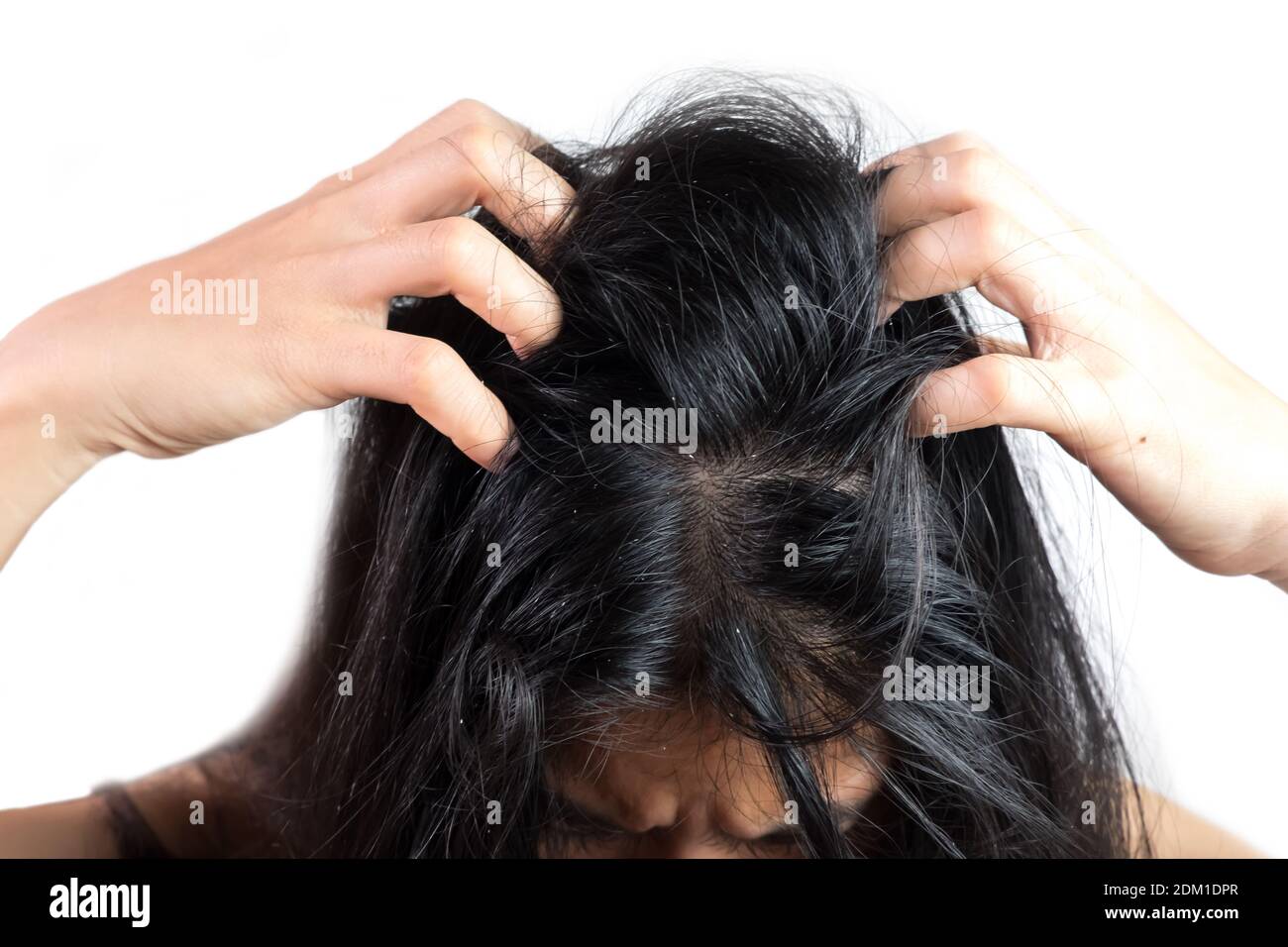 Dandruff black hi-res stock photography and images - Alamy