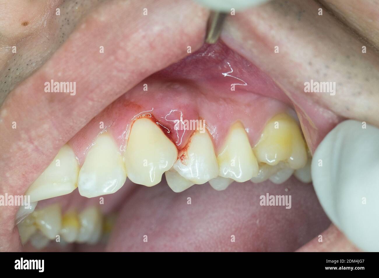 Gum bleeding hi-res stock photography and images - Alamy