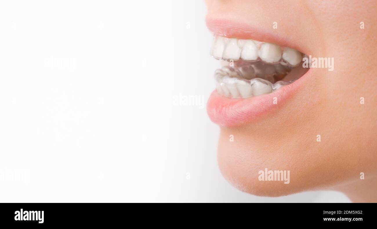 A side view of a womans smile in transparent and removable aligners ...