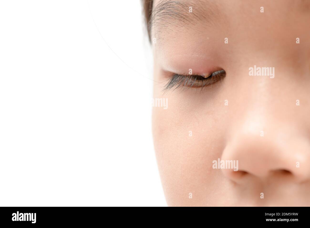 Meibomian Gland High Resolution Stock Photography and Images - Alamy