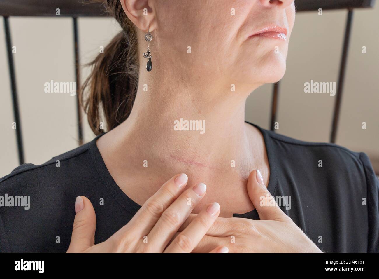 Chest Scar High Resolution Stock Photography and Images - Alamy