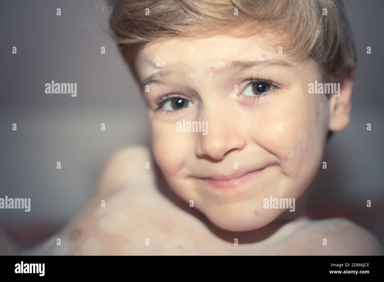 Boy With Chickenpox High Resolution Stock Photography and Images - Alamy