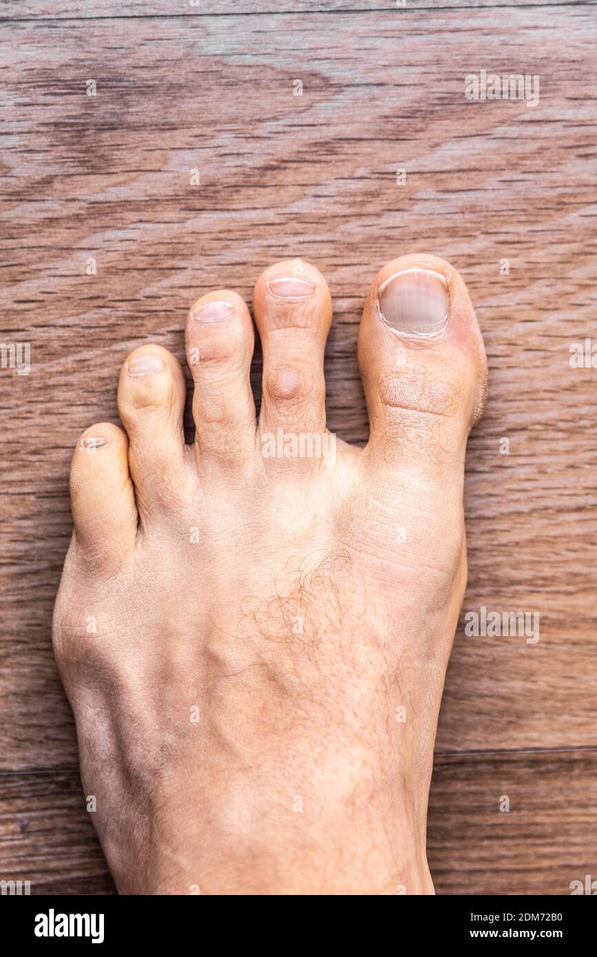 Dermatophytes High Resolution Stock Photography and Images - Alamy