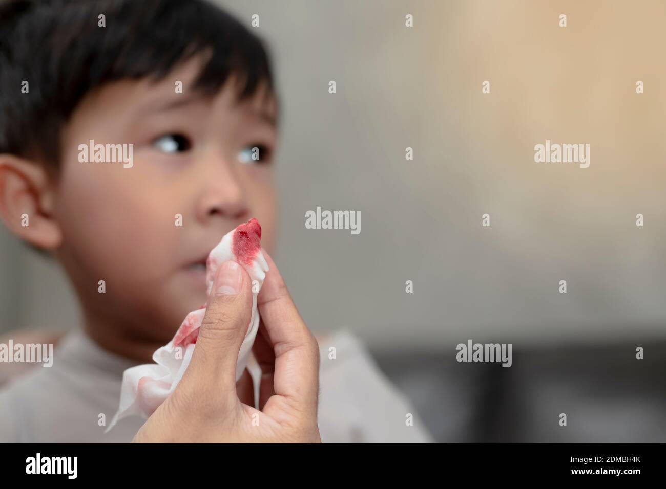 Epistaxis hi-res stock photography and images - Alamy