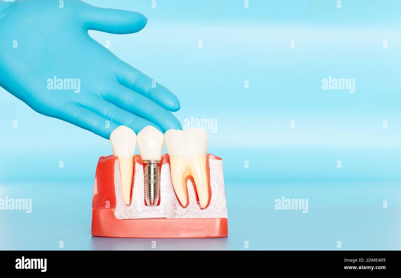 Types Of Teeth High Resolution Stock Photography and Images - Alamy