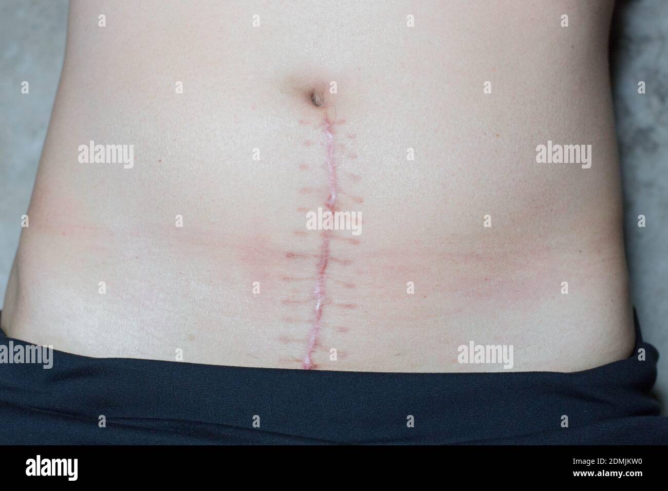 Stomach stitches hi-res stock photography and images - Alamy