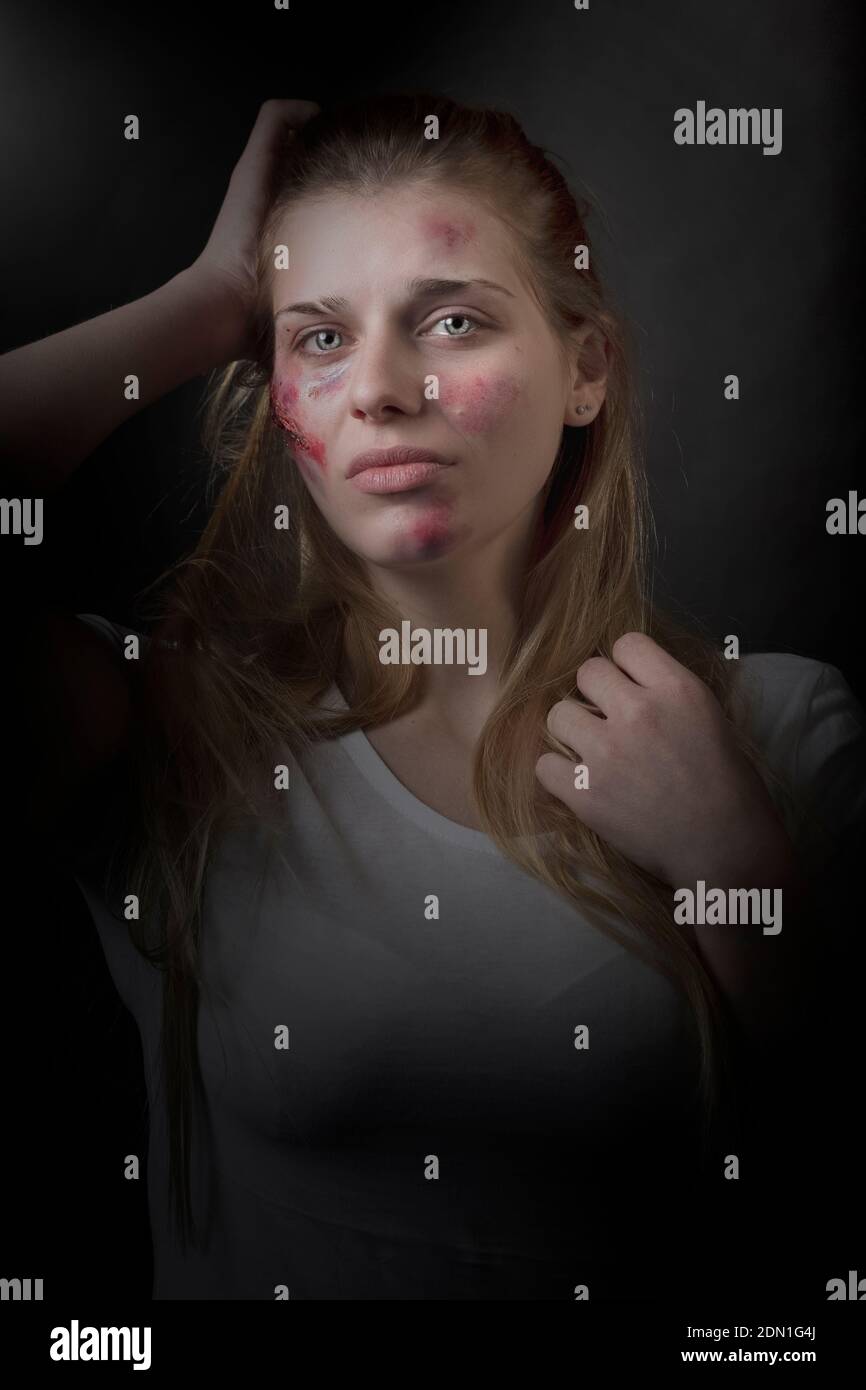 Bruises on face hi-res stock photography and images - Alamy
