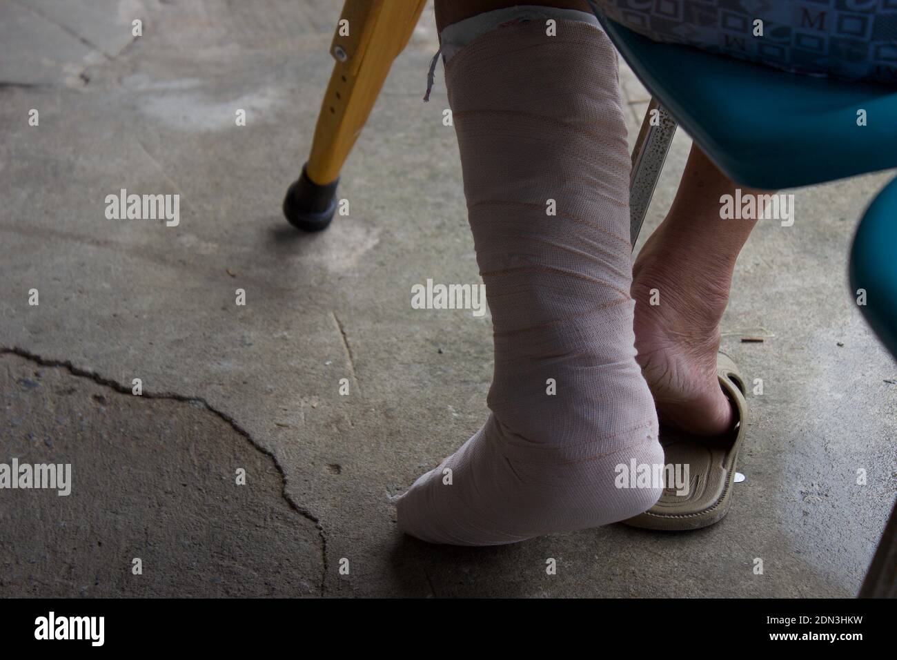 Fractured limb hi-res stock photography and images - Alamy