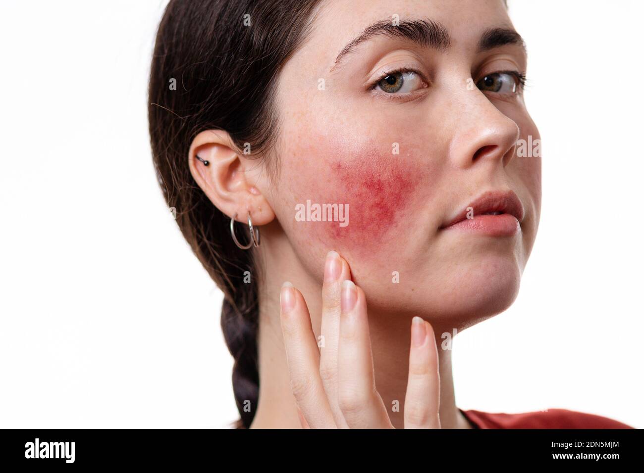 Rosacea Cheeks