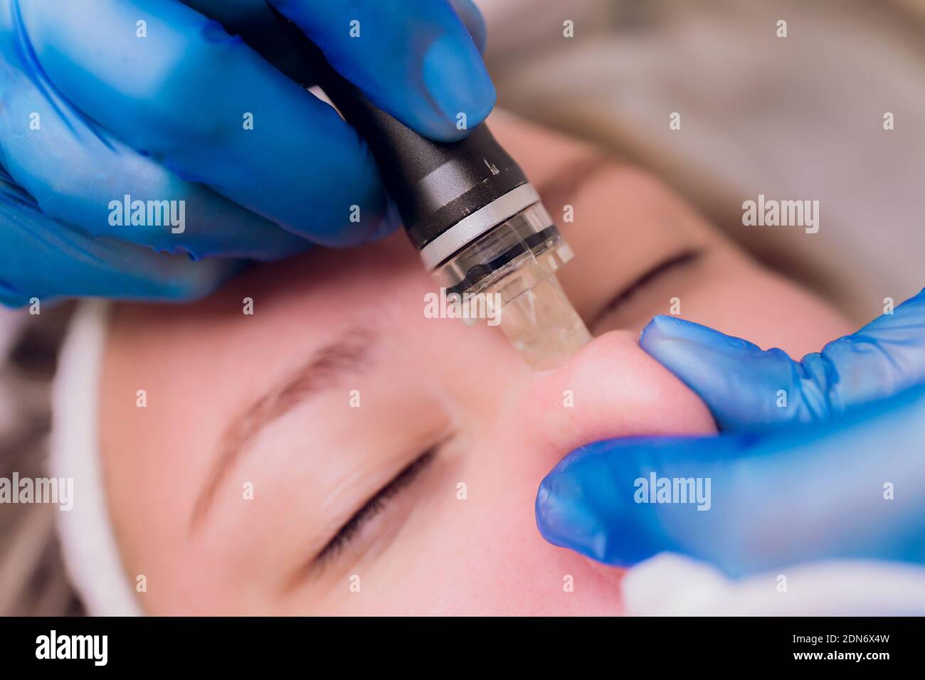 Woman cleaning nose skin pores using vacuum blackhead remover, cosmetic ...