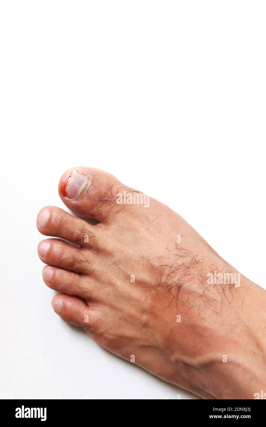 Wounded limb hi-res stock photography and images - Alamy