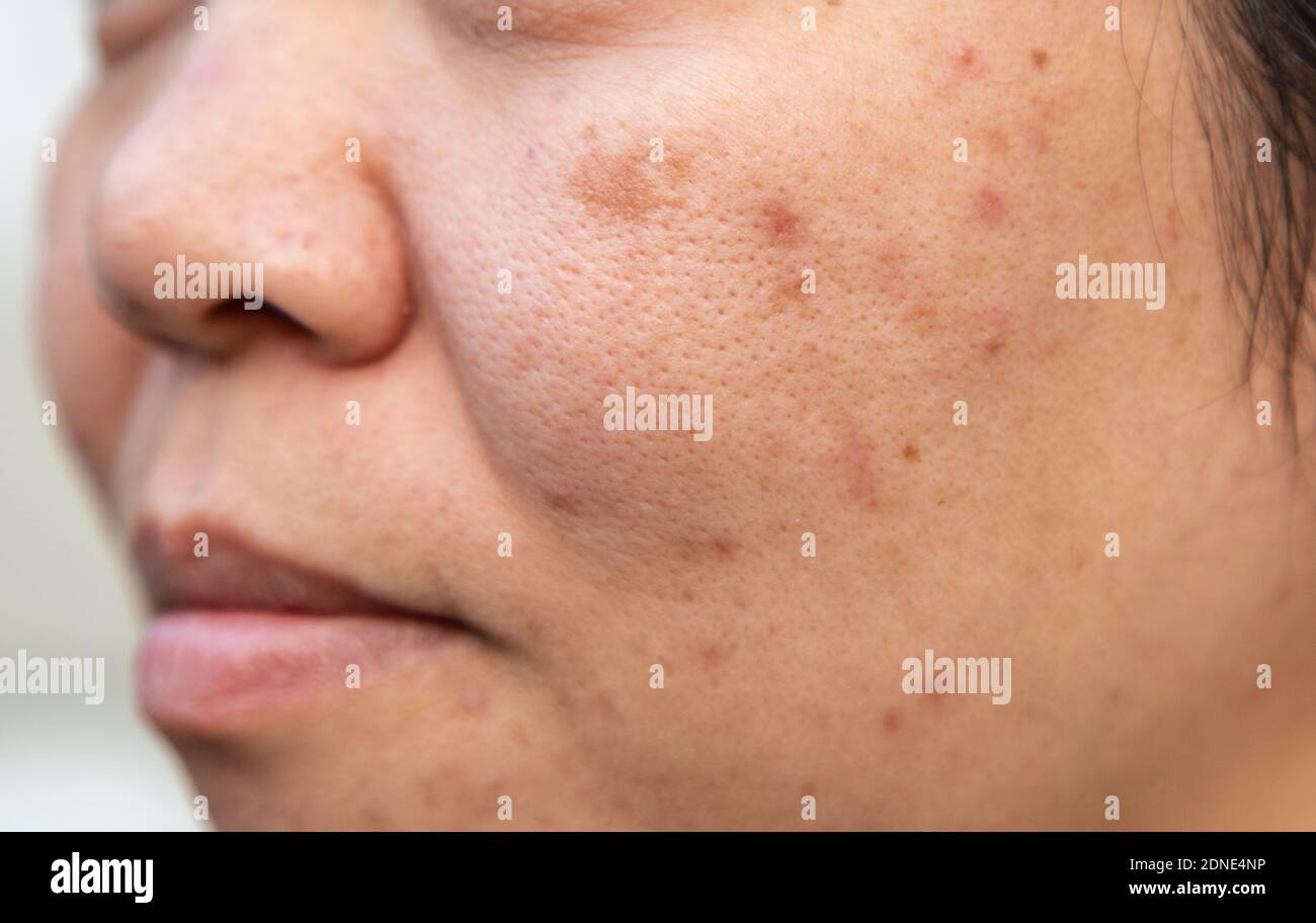 Mature Woman Acne Face High Resolution Stock Photography and Images - Alamy
