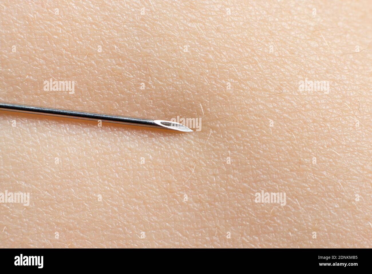 Macro photo of a medical needle with a syringe on a person's body on ...