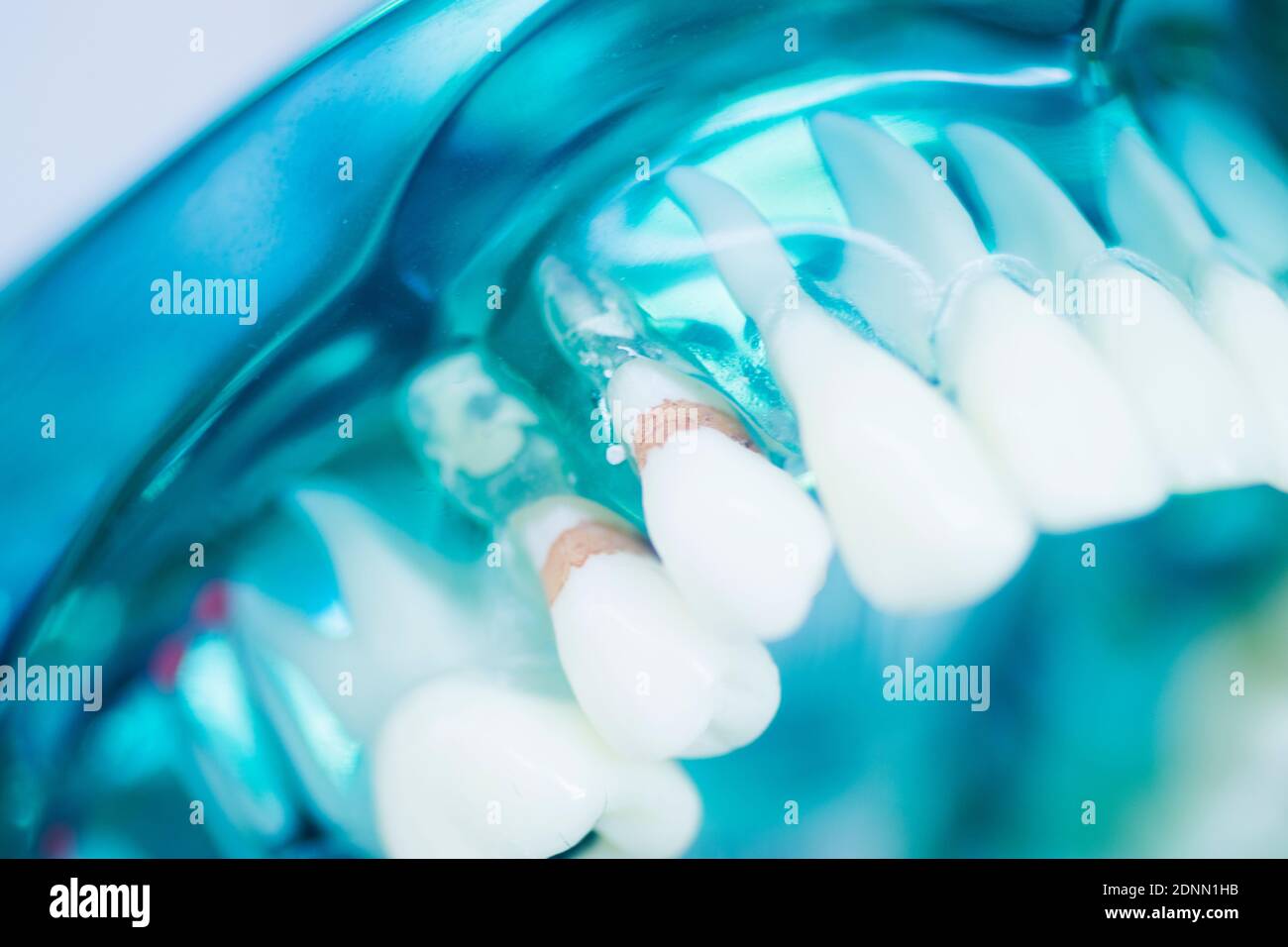 Teeth decay dentistry model showing caries in tooth Stock Photo - Alamy