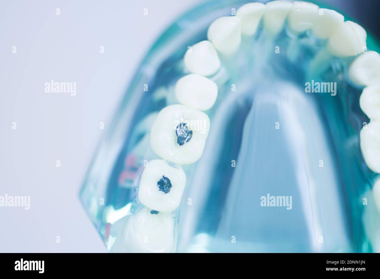 Teeth decay dentistry model showing caries in tooth Stock Photo - Alamy
