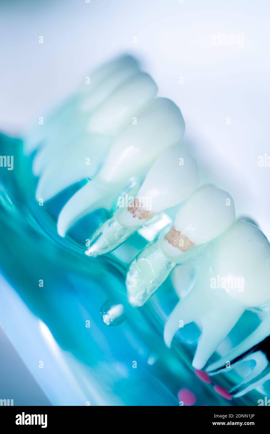 Teeth decay dentistry model showing caries in tooth Stock Photo - Alamy
