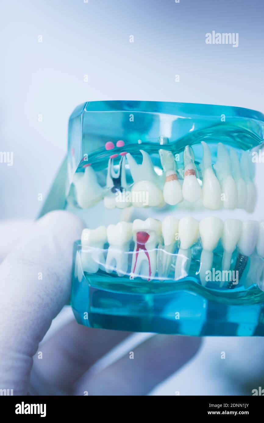 Teeth decay dentistry model showing caries in tooth Stock Photo - Alamy