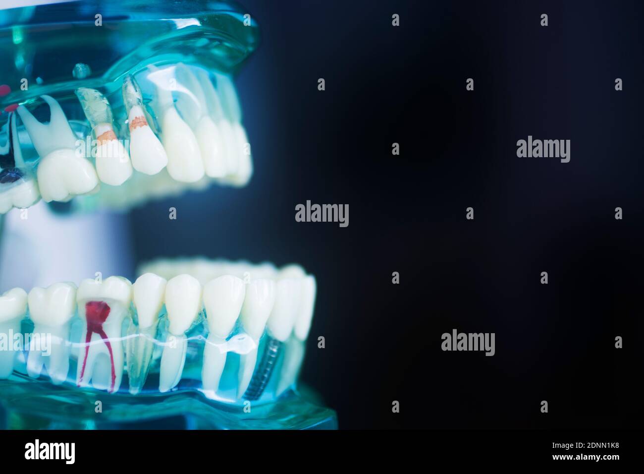 Teeth decay dentistry model showing caries in tooth Stock Photo - Alamy