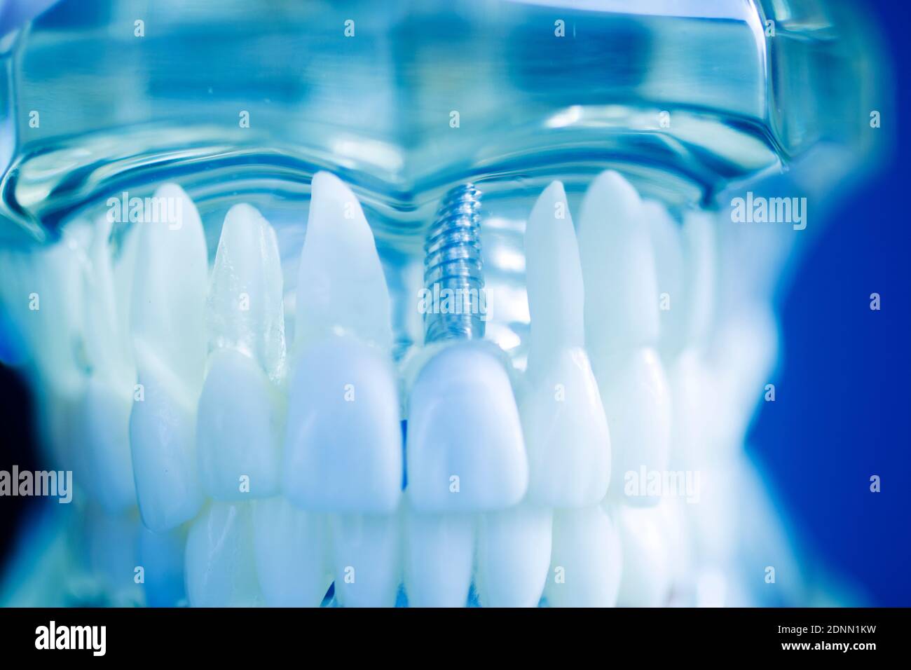 Dental tooth implant titanium prosthetic dentists model Stock Photo - Alamy