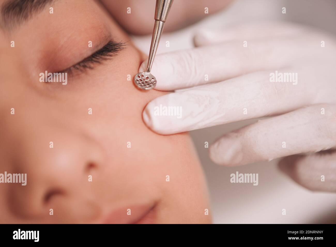 Close up shot of a dermatologist using blackhead remover, cleansing ...