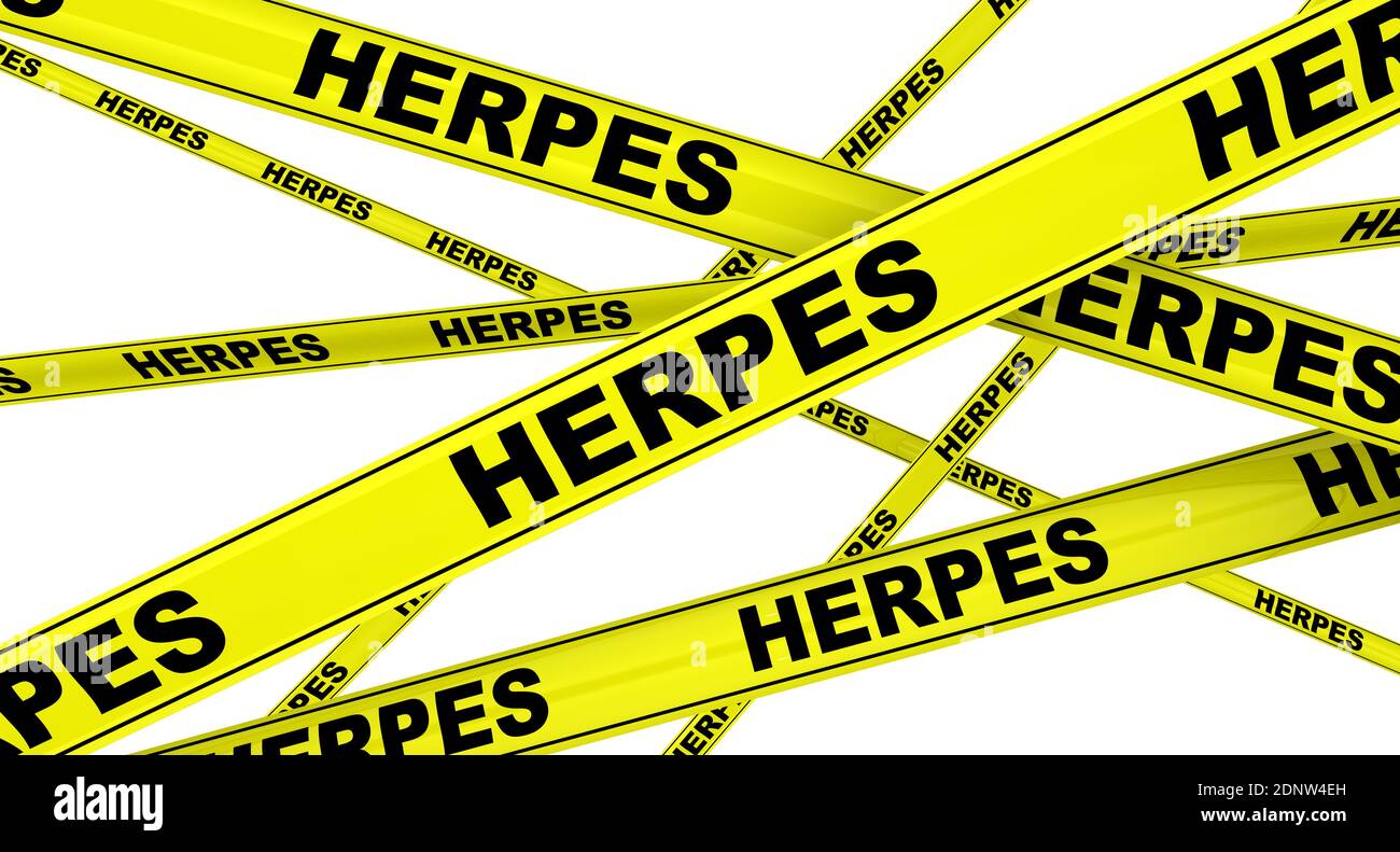 Herpes. Yellow warning tapes with black words HERPES (group of viral ...