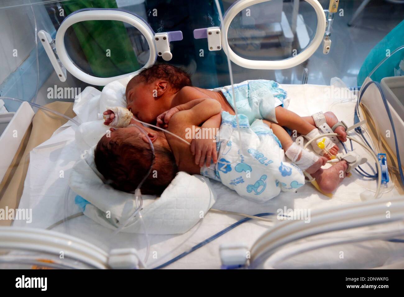 Conjoined twins born hi-res stock photography and images - Alamy