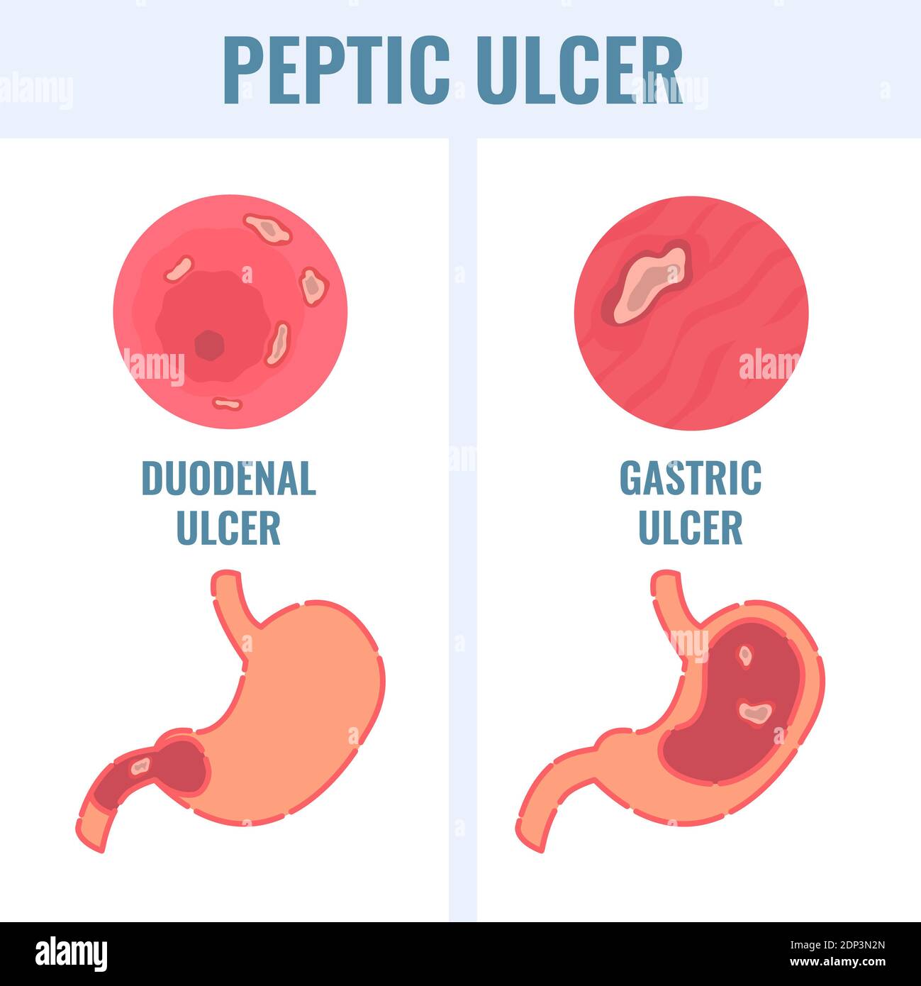 Gastric Ulcer