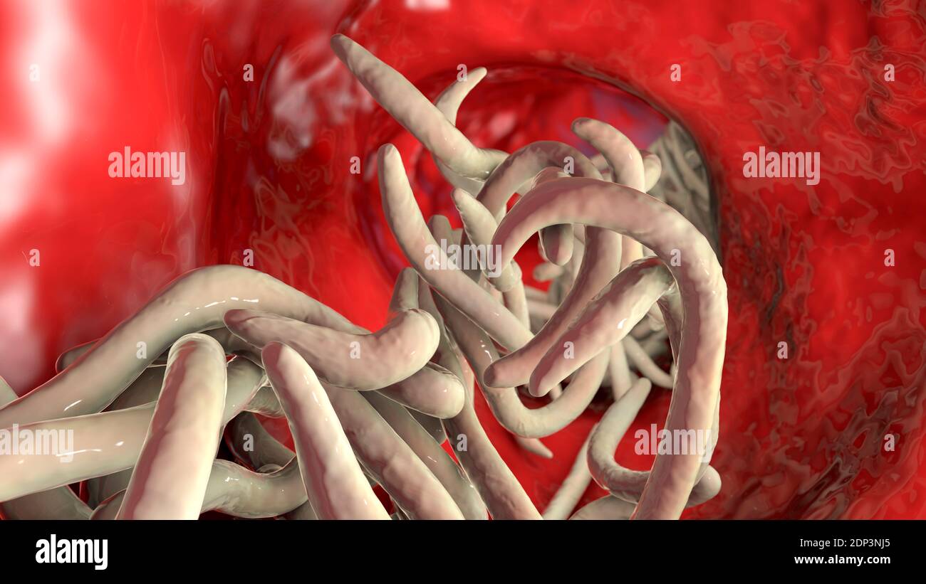 Round worms in human intestine, computer illustration. Roundworms, or ...