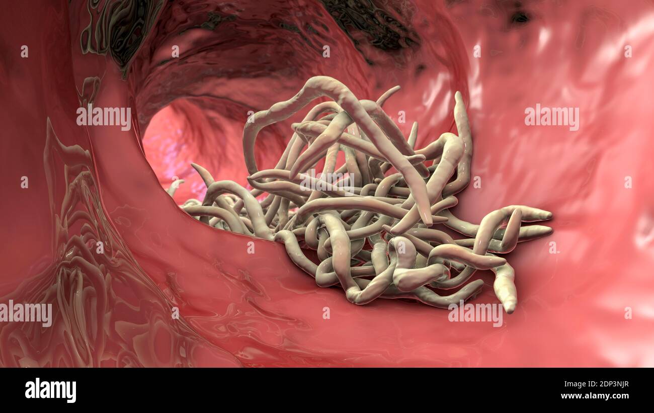 Round worms in human intestine, computer illustration. Roundworms, or ...