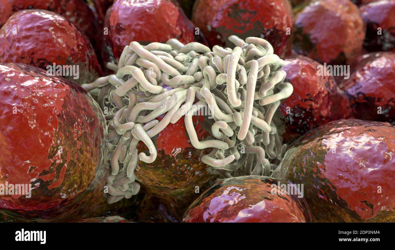 Round worms in human intestine, computer illustration. Roundworms, or ...