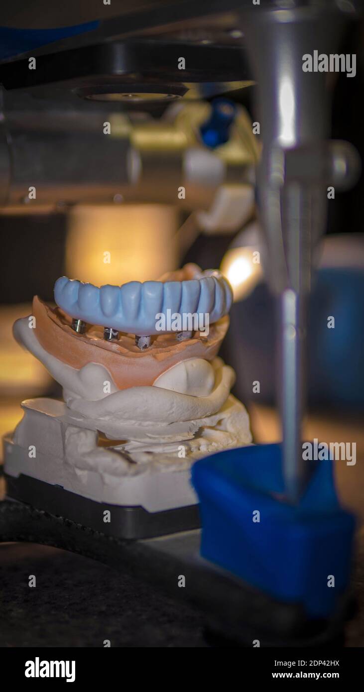 Dental prosthetics, model with installed teeth in a prosthesis ...