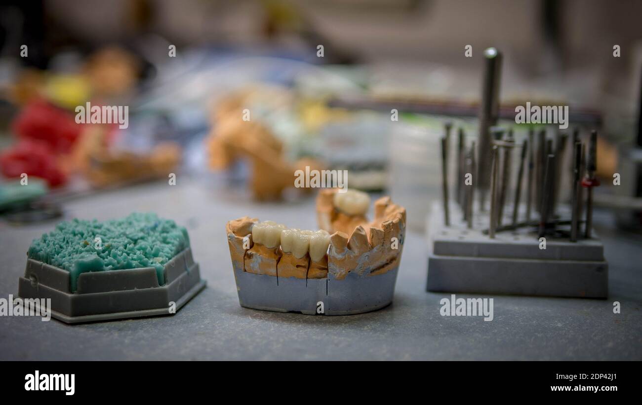 Dental prosthetics, model with set teeth in a prosthesis. Plaster model ...