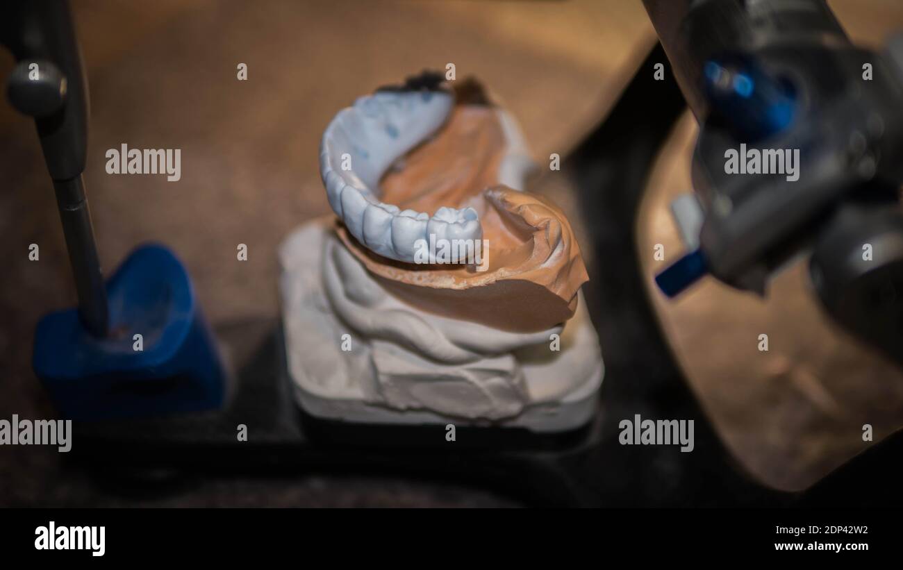 Dental prosthetics, model with installed teeth in the prosthesis ...