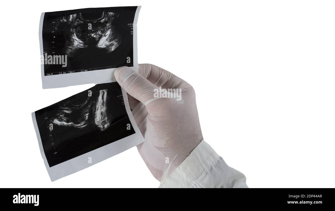 Ultrasound of male prostate isolated on white background, doctor holds ...