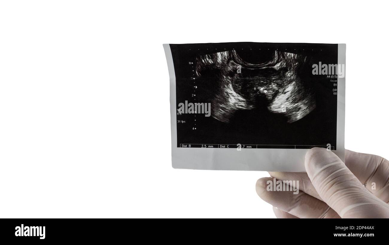 Ultrasound of the prostate on an isolated white background. The doctor ...