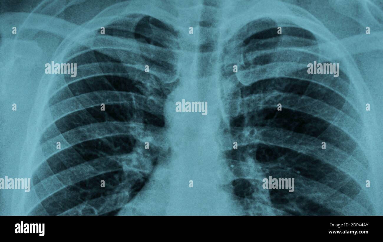 X-ray of human lungs close-up Stock Photo - Alamy